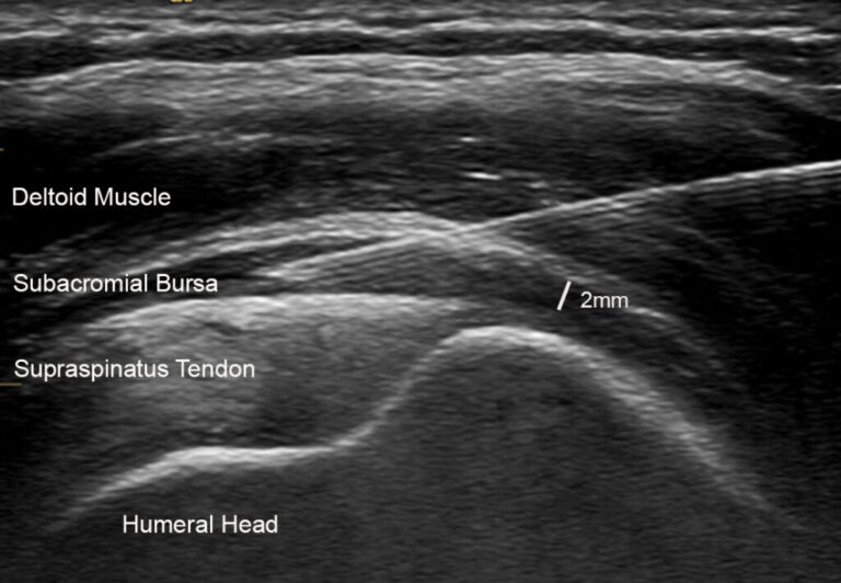 IMAGING-GUIDED MANAGEMENT OF SHOULDER PAIN - Panorama Radiology Specialists
