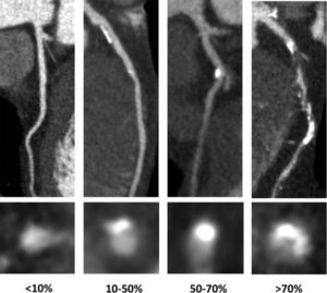 'SOFT PLAQUE MATTERS': LOW-DOSE CT CORONARY ANGIOGRAPHY USING 640-SLICE ...