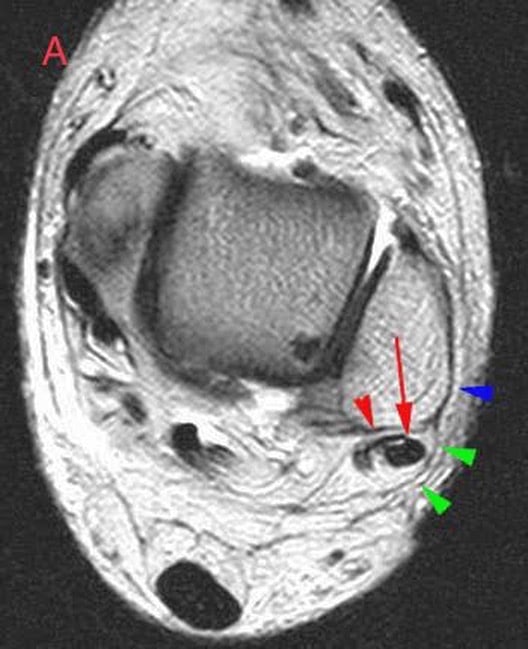 PERONEAL TENDON INJURIES - A COMMONLY OVERLOOKED CAUSE OF CHRONIC ANKLE ...