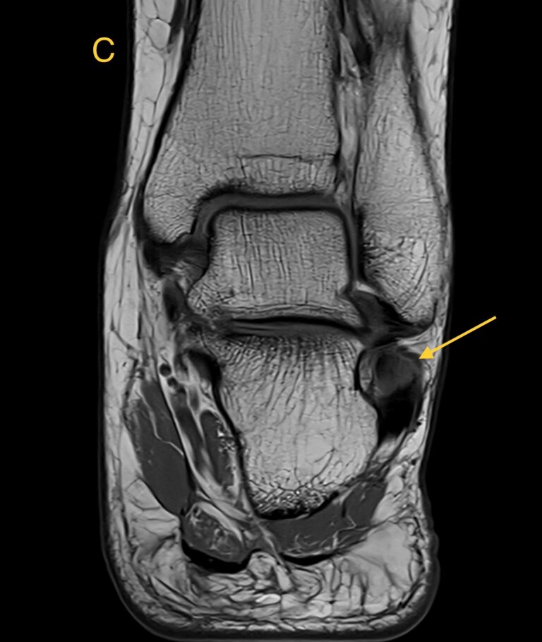 PERONEAL TENDON INJURIES - A COMMONLY OVERLOOKED CAUSE OF CHRONIC ANKLE ...