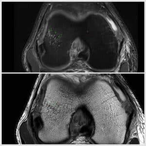 ENHANCED DETECTION OF MICROTRABECULAR FRACTURES USING 3T MRI WITH DEEP ...