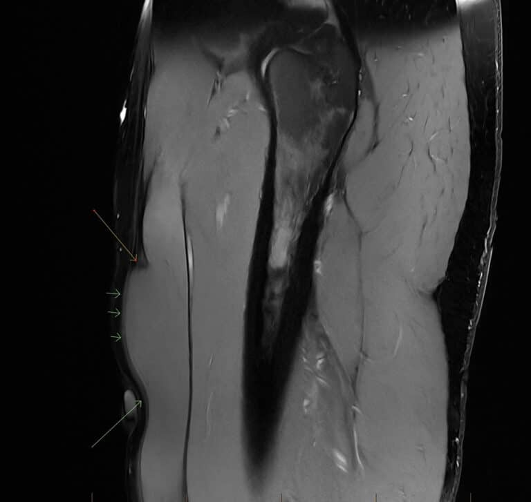 CASE STUDY : An Unusual Myofascial Quadriceps Hernia Diagnosed with 3T ...