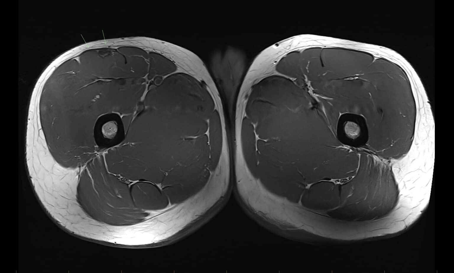 CASE STUDY : An Unusual Myofascial Quadriceps Hernia Diagnosed with 3T ...